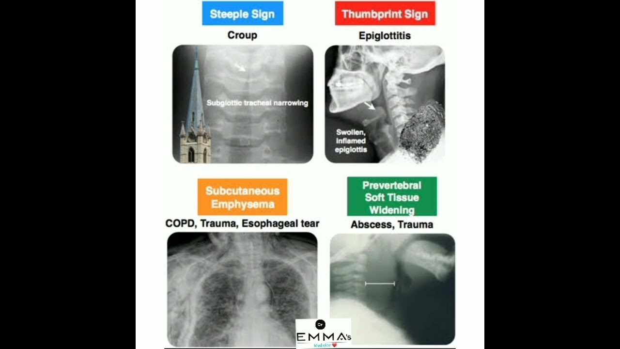 Epiglottitis Thumbprint Sign