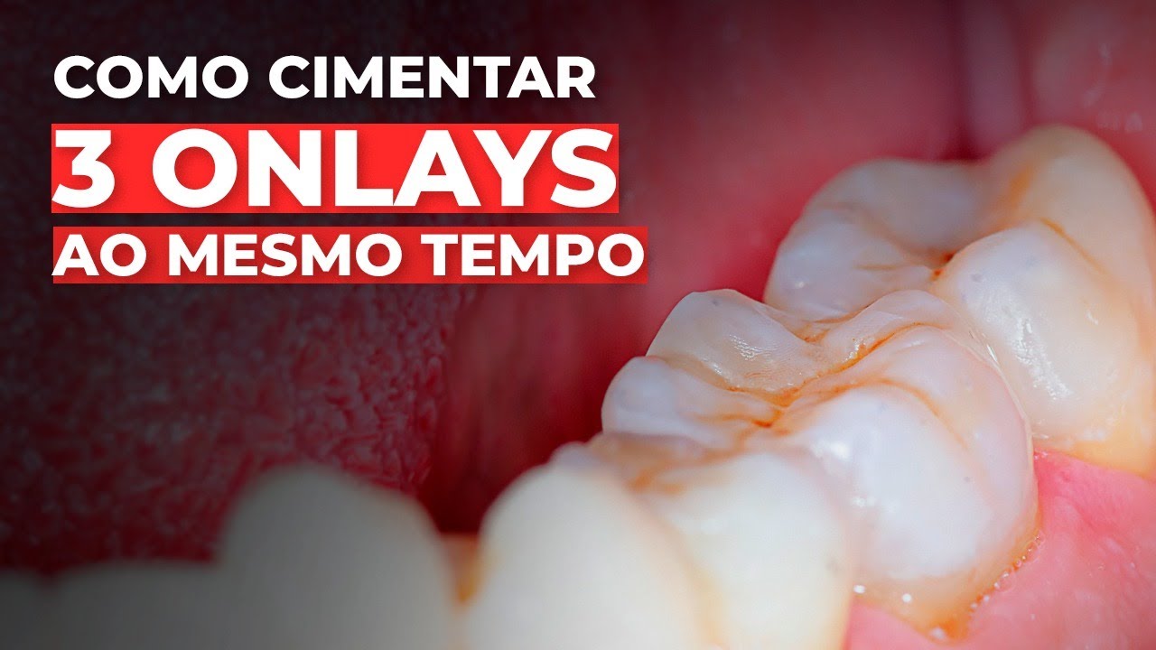 Como cimentar 3 onlays ao mesmo tempo - Mylene e Renato - YouTube