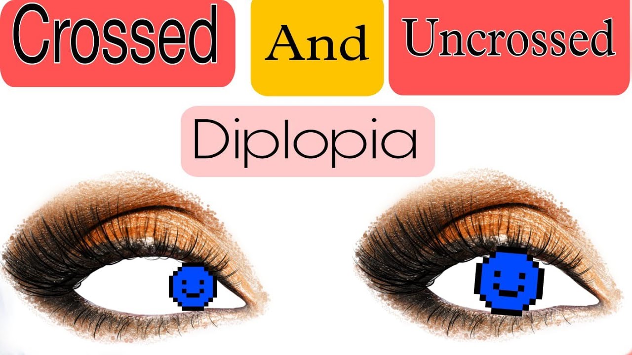 Crossed and uncrossed diplopia|Reason behind this| - YouTube