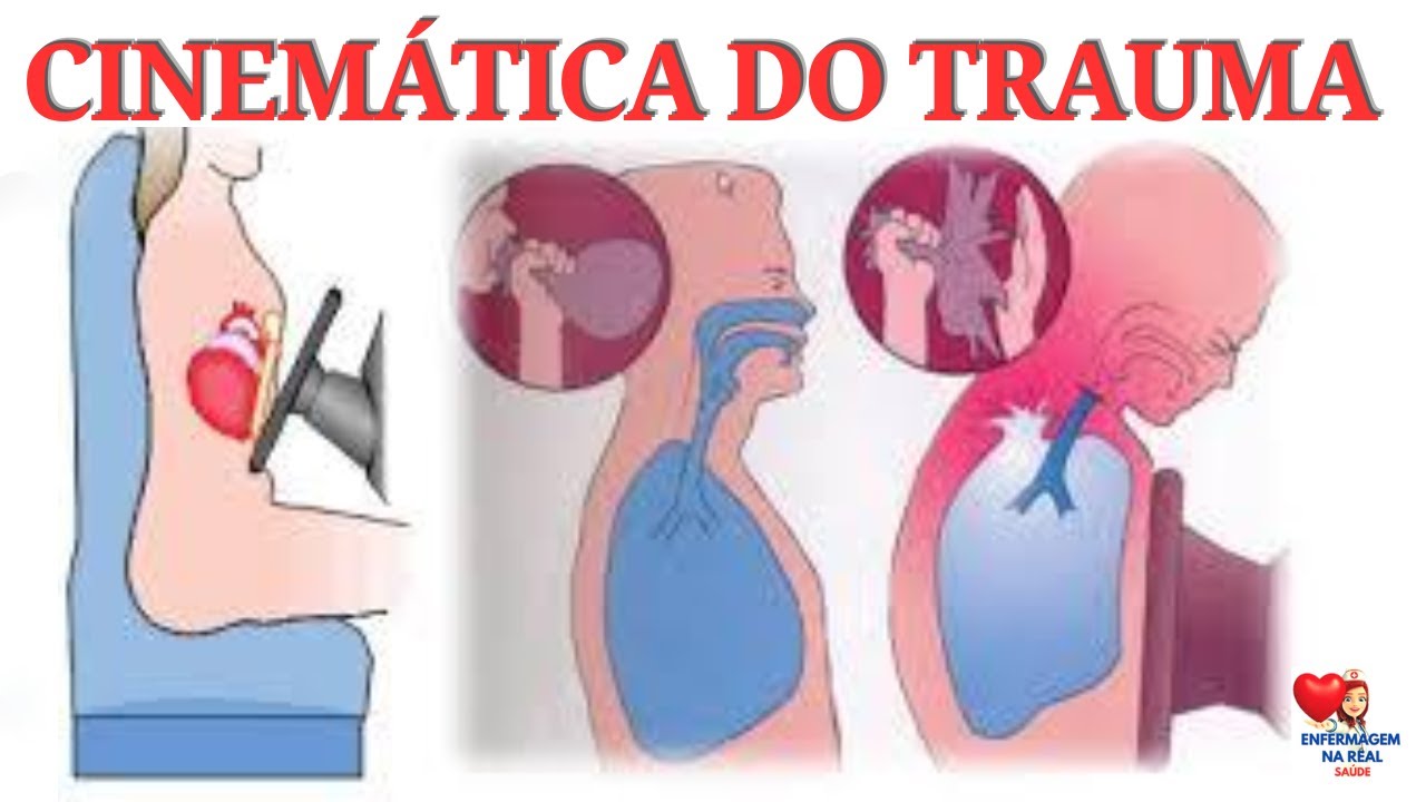 CINEMÁTICA DO TRAUMA: Como Avaliar a Cena, Identificar Acidentes Graves ...