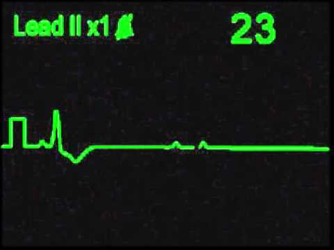 3rd Degree AV Block - ECG Simulator - Arrhythmia Simulator - YouTube