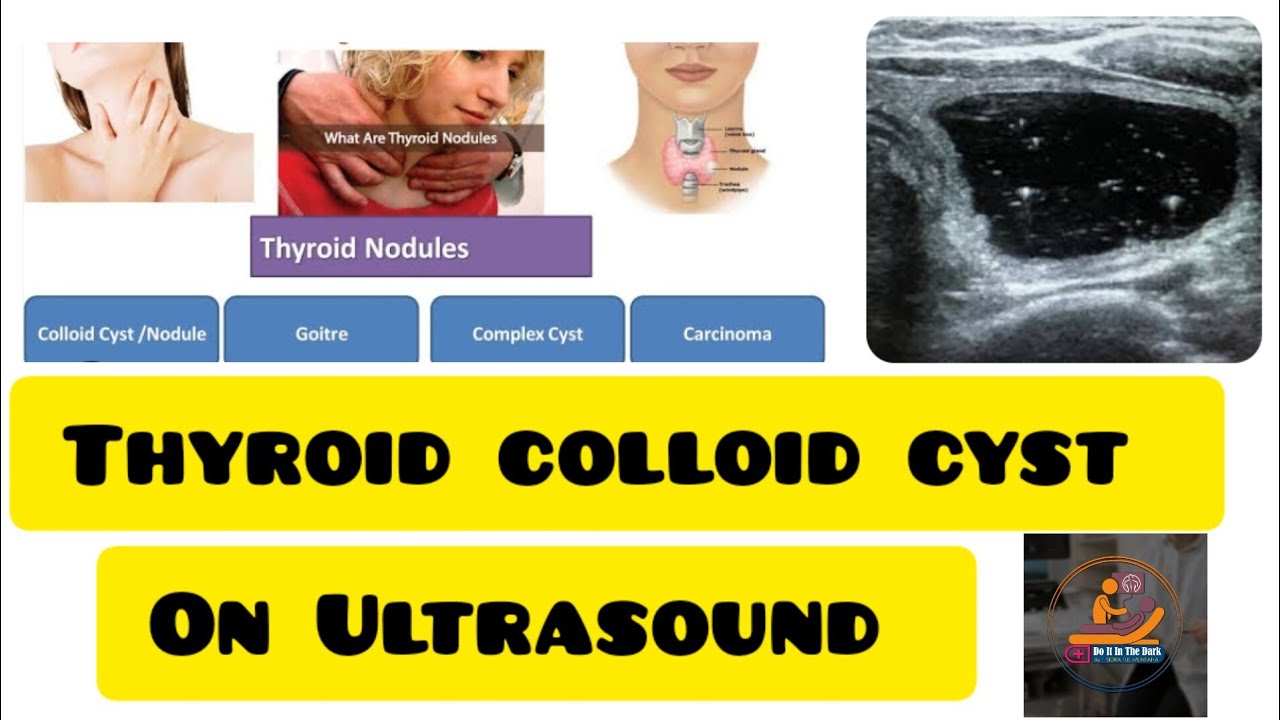 Thyroid colloid cyst #radiology #ultrasonography#health#ultrasoundscans ...