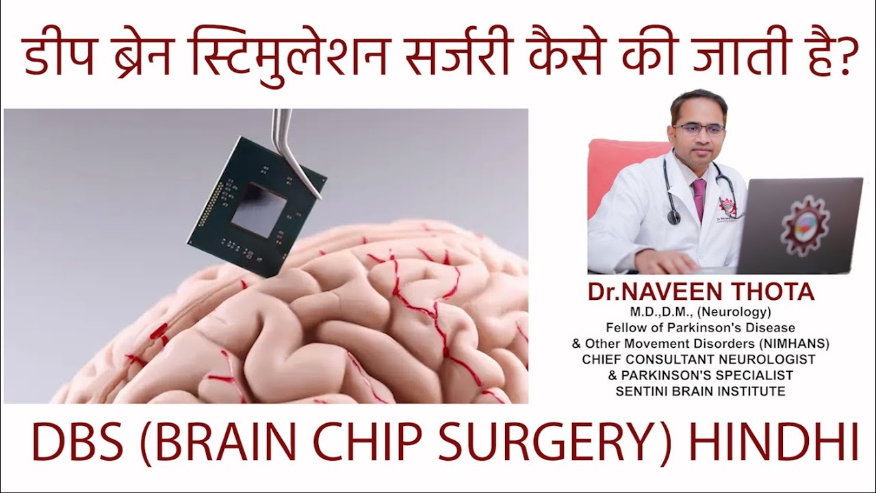 डीप ब्रेन स्टिमुलेशन सर्जरी कैसे की जाती है? /DBS (BRAIN CHIP SURGERY ...