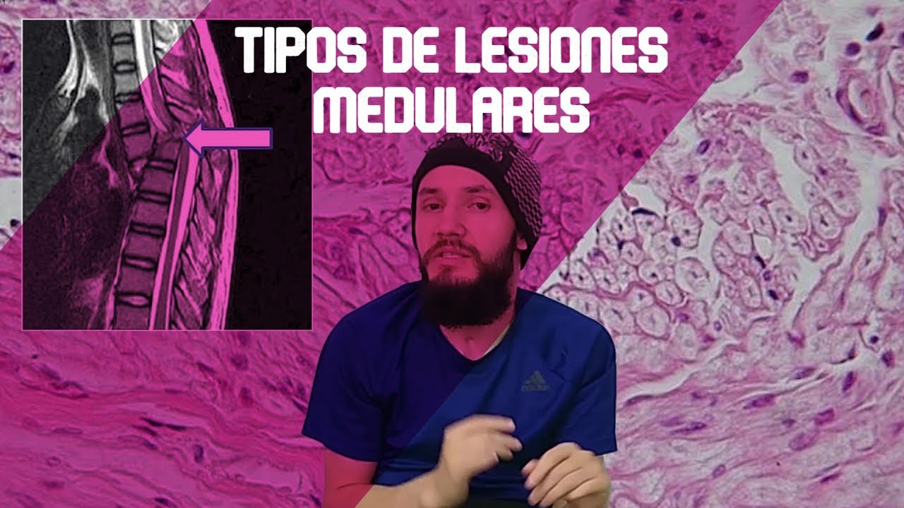LESIÓN MEDULAR: Tipos de lesión medular y CAUSAS - YouTube