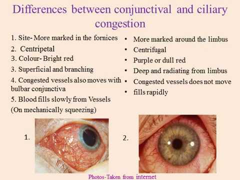 Red eye - causes of red eye, different types of ocular congestion and ...