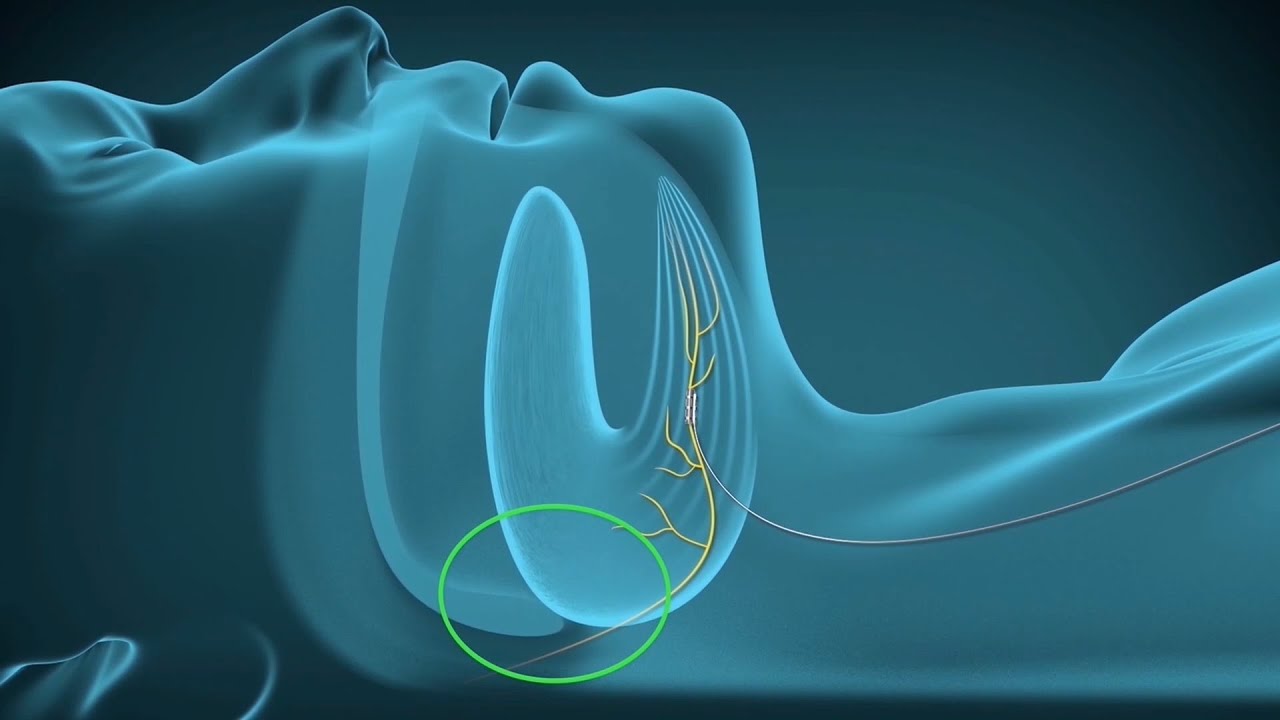 A New Way to Treat Sleep Apnea - Hypoglossal Nerve Stimulator - CHI ...