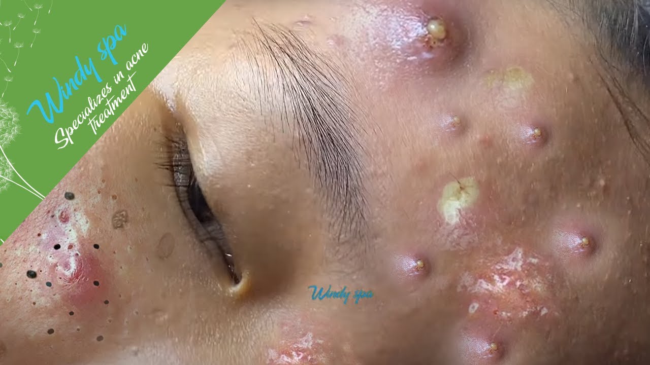 (Acne Treatment for Ban Part 2) - Make Your Day Relaxing with Windy Spa ...