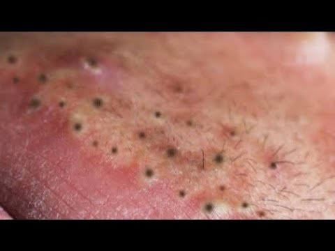 Blackhead popping removal ASMR **LIP BLACKHEAD REMOVAL!!!!** - YouTube
