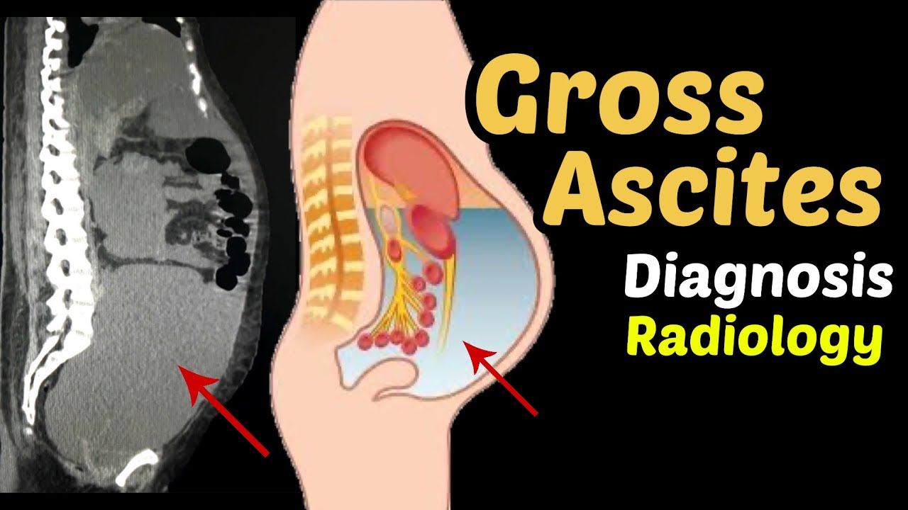 Gross Ascites-Diagnosis| Abdominal fluid | CT scan Abdomen | Radiology ...