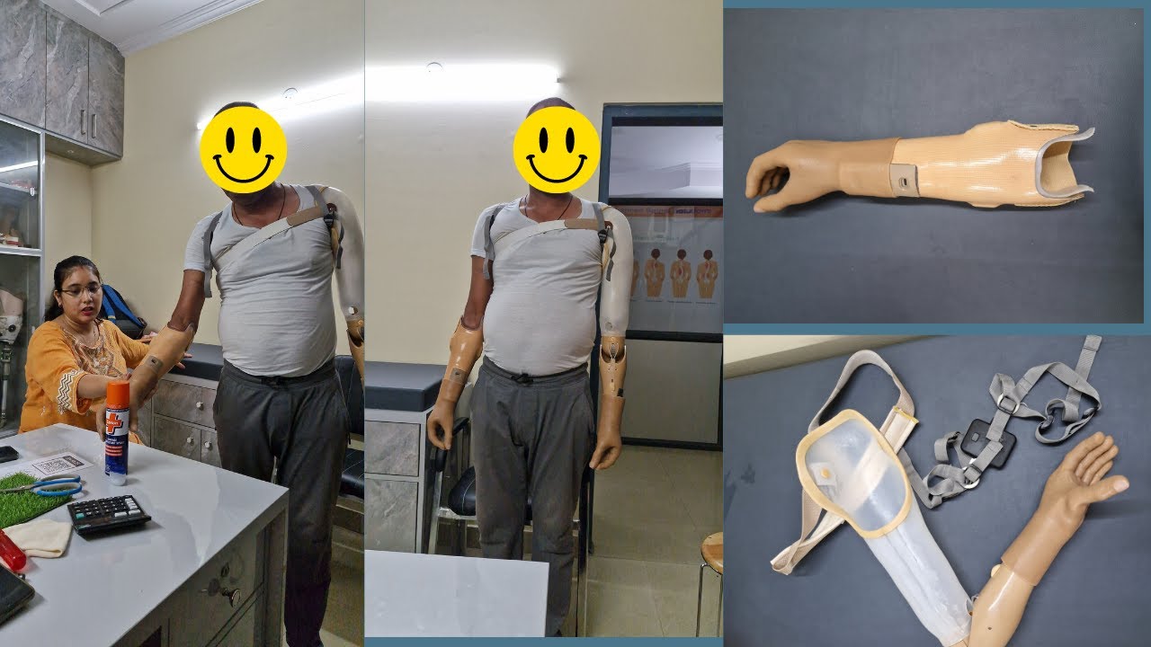 Bilateral Myo Electric Hands I सेंसर वेले नकली डोनो हाथ I #9643560798 ...