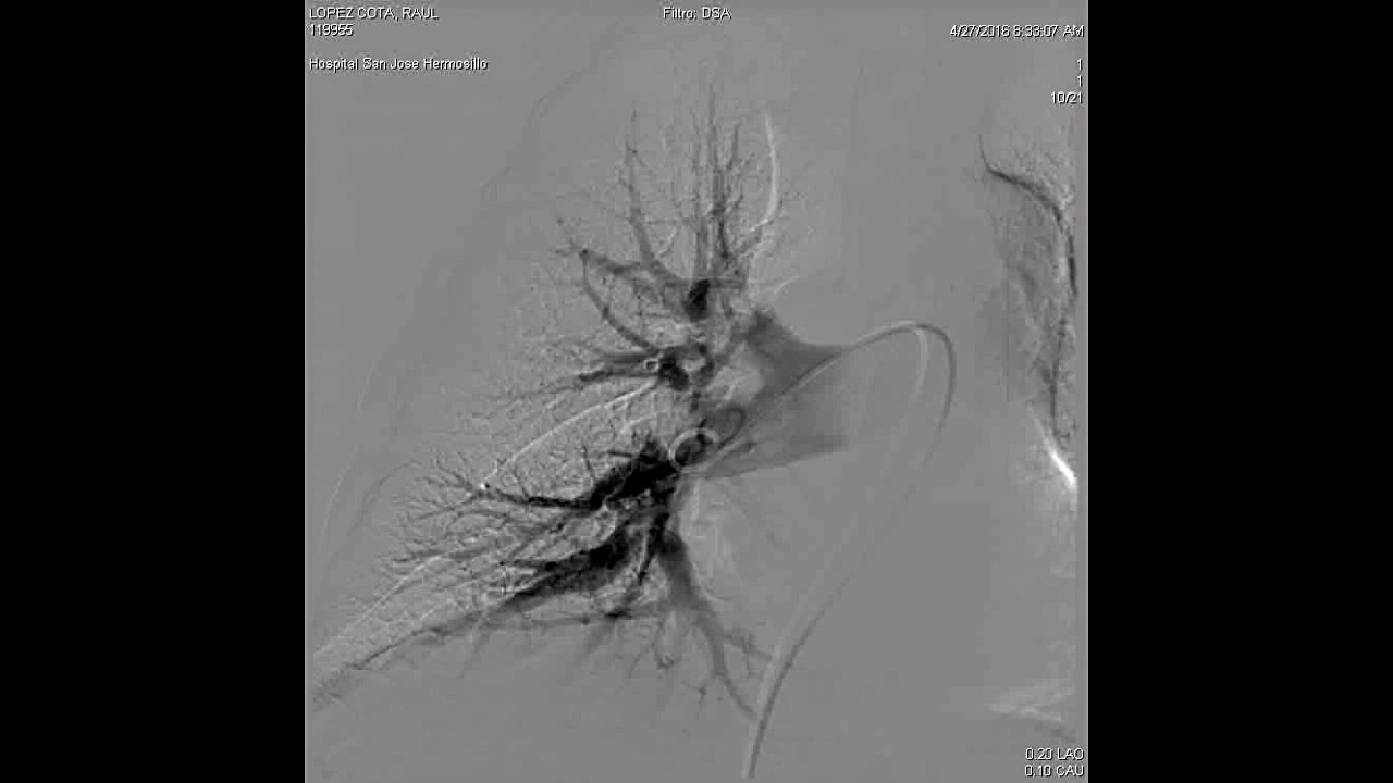 TROMBOLISIS CON ASISTENCIA POR CATETER (EKOS) - YouTube
