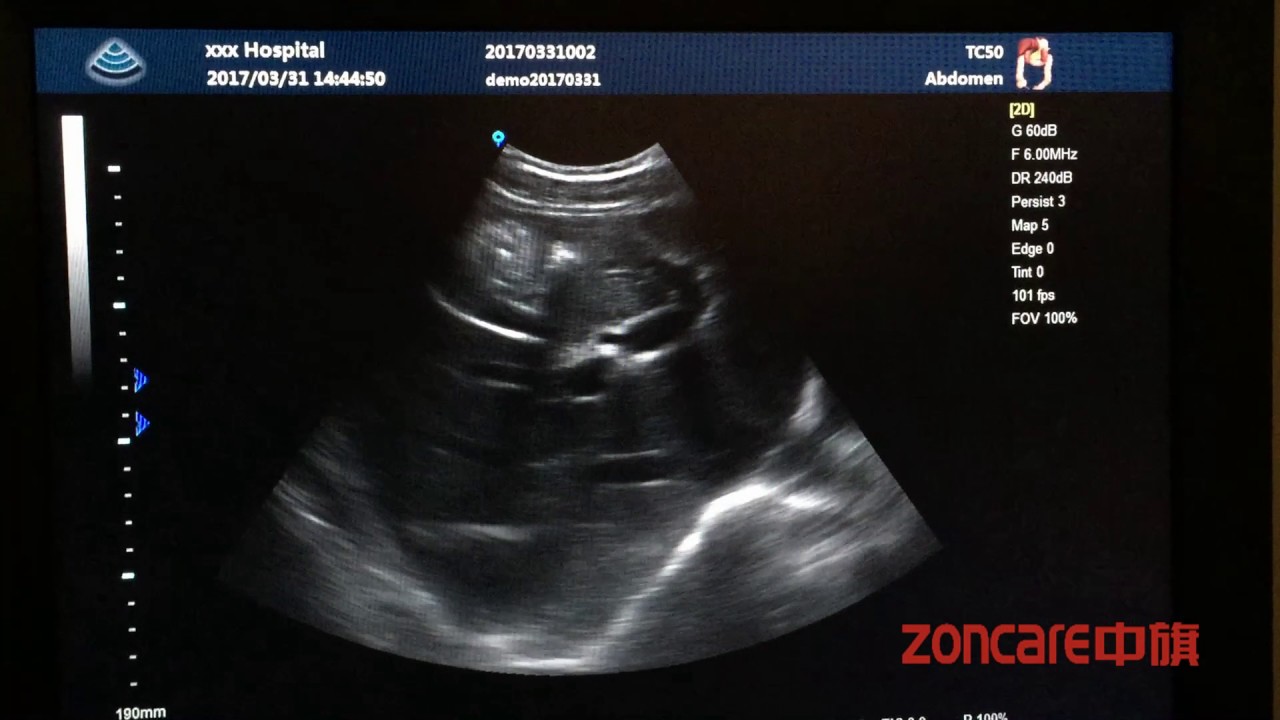 Zoncare Q3 -Full digital color doppler Ultrasound system - YouTube