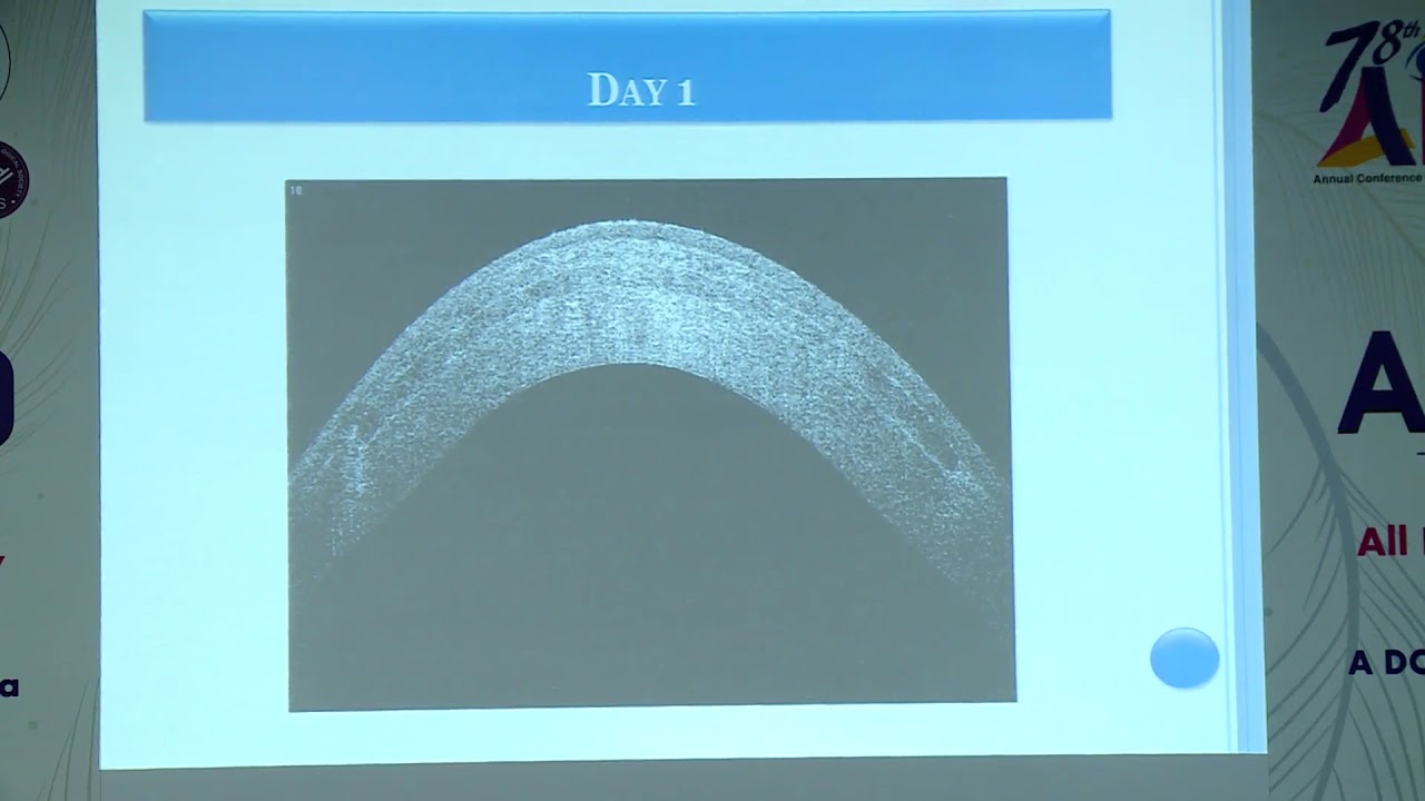 AIOC2020 IC546 T4 Dr Rajesh Sinha Intrastromal Lenticule Implantation ...