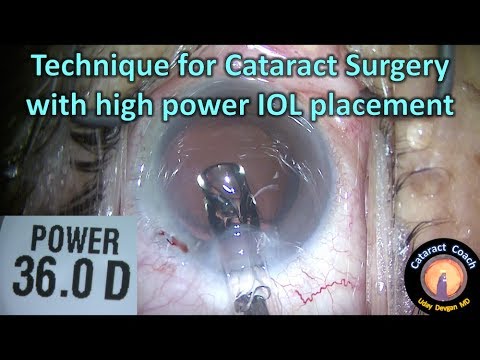 Cataract Surgery with High Power IOL placement - YouTube