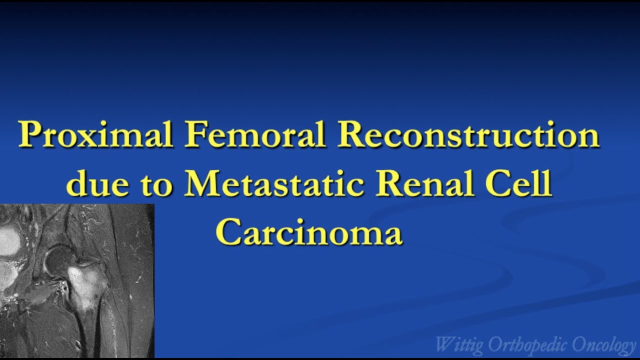 Limb Sparing Resection of the Proximal Femur due to Metastatic Renal ...