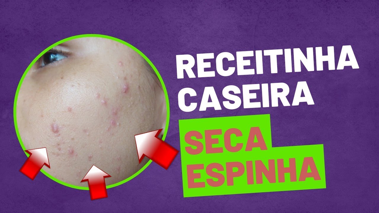 Como secar espinha rápido, receita caseira e baratinha que dá muito ...