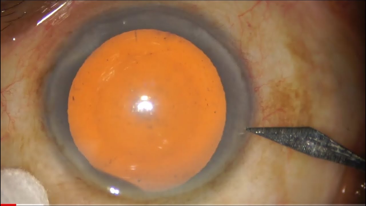 Cortex wash with Phaco Hand Piece - Dr Ramakrishna Tadanki - YouTube