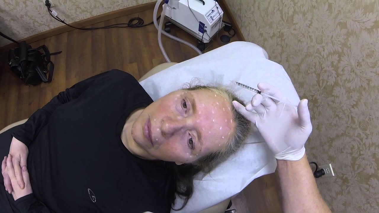 Botox Injections (Brow Lift) | Huntington, Long Island NY Plastic ...
