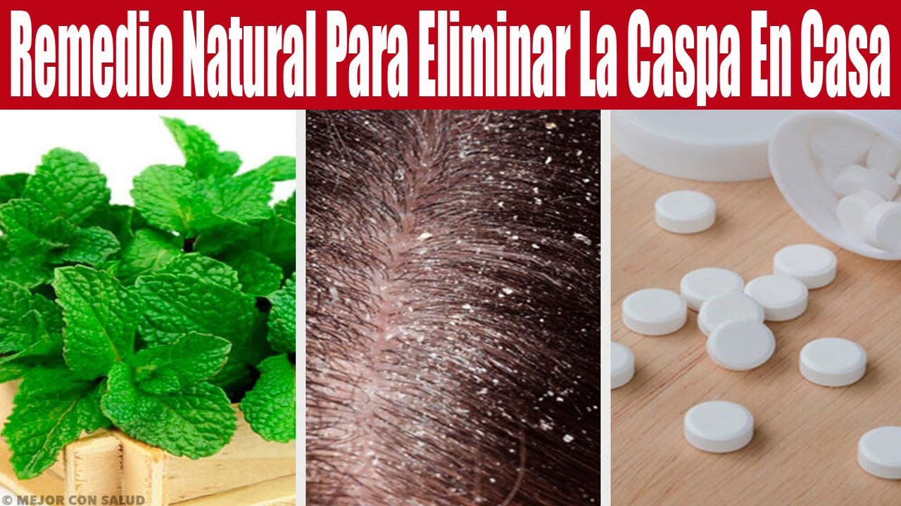 Remedio Natural para la Caspa con Ingredientes Caseros: Efectivo y ...