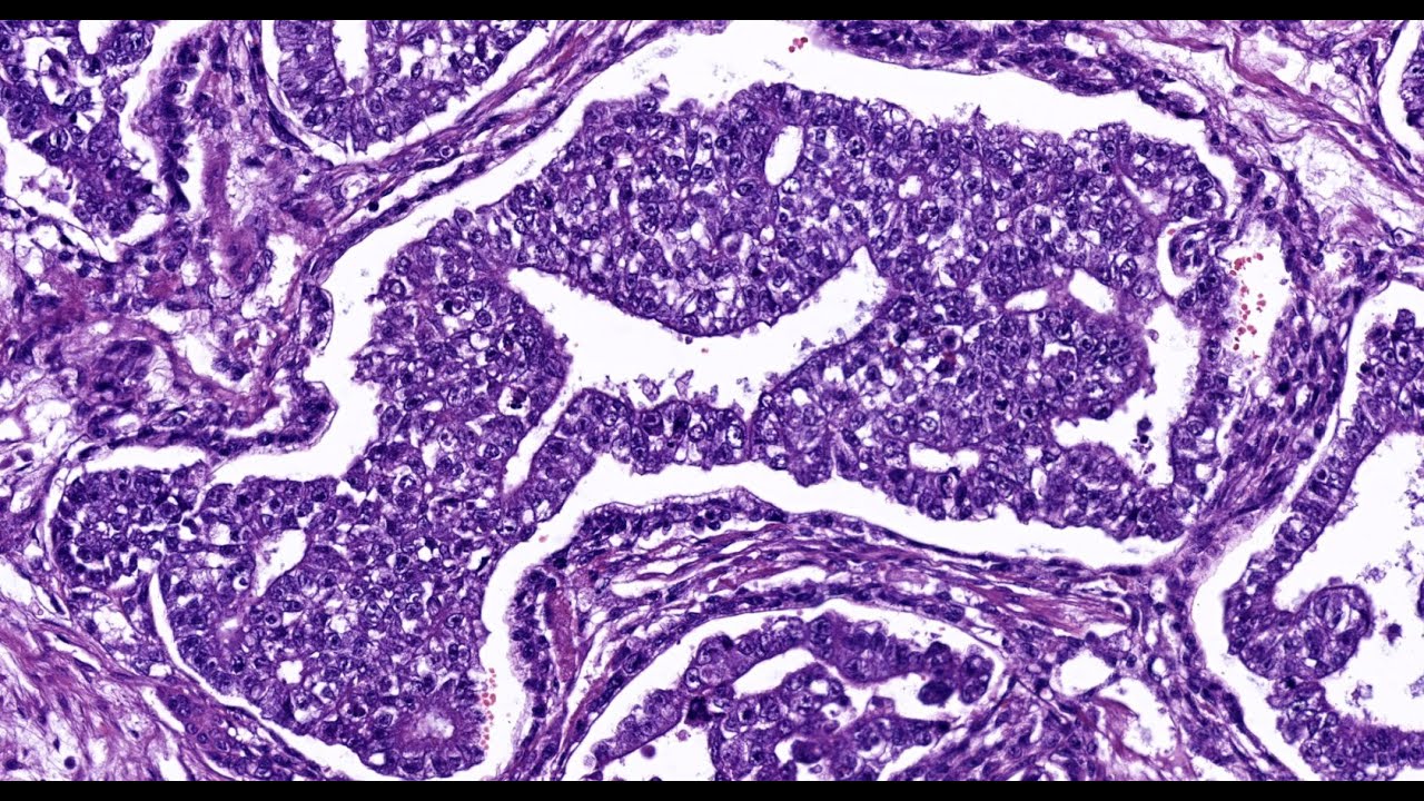 Mixed germ cell tumors - diffuse embryoma (high-yield, short ...