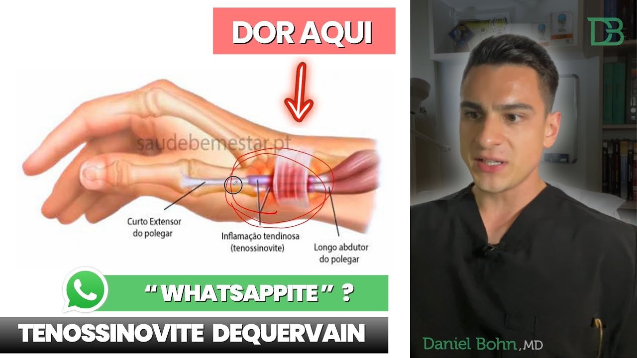 Tenossinovite de De Quervain: Causas, Diagnóstico e Tratamento (Com ...