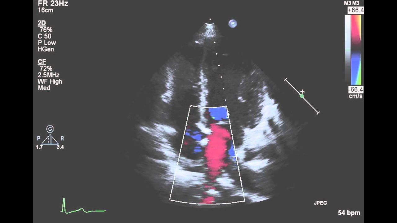 TTE Normal Apical 4 chamber Pulmonary vein color Example 1 - YouTube