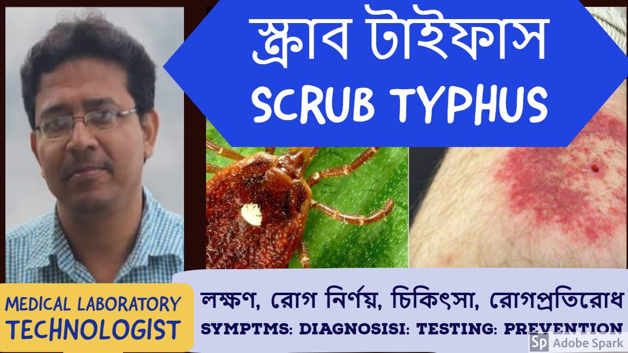 Scrub Typhus: Symptoms:Diagnosis & Testing:Treatment:Prevention:স্ক্রাব ...