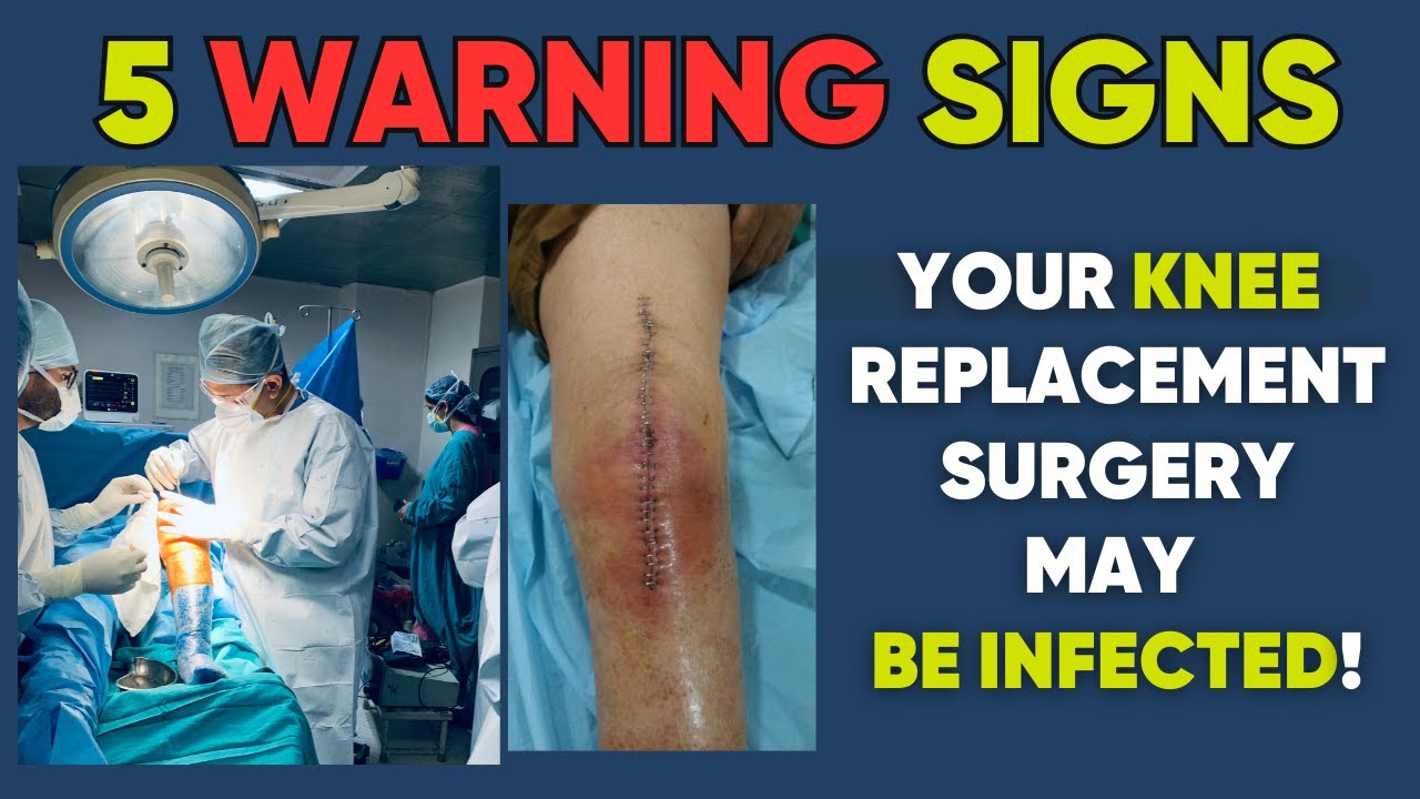 Top 5 warning signs of infection in knee replacement I घुटने की सर्जरी ...