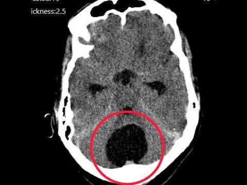 Massive brain cyst &Hydrocephalus - YouTube