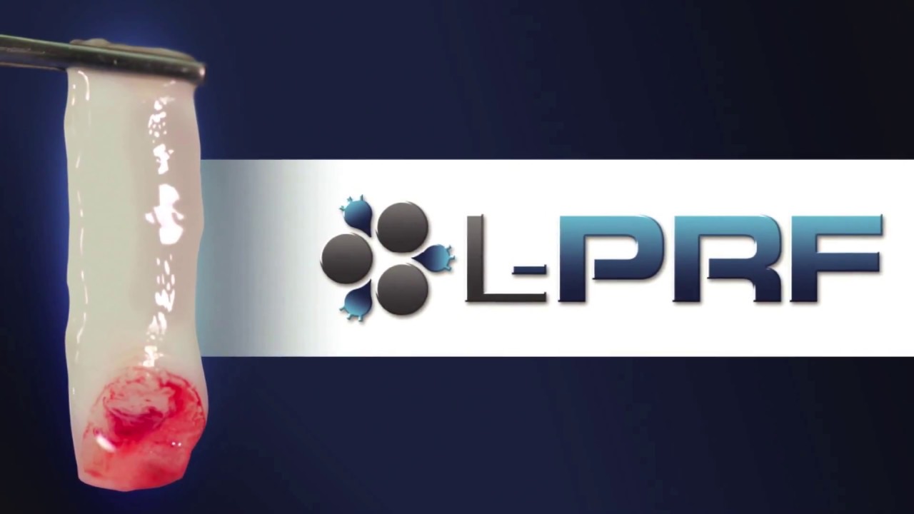 L-PRF (Leukocyte-Platelet Rich Fibrin) Bone Grafting for Dental ...