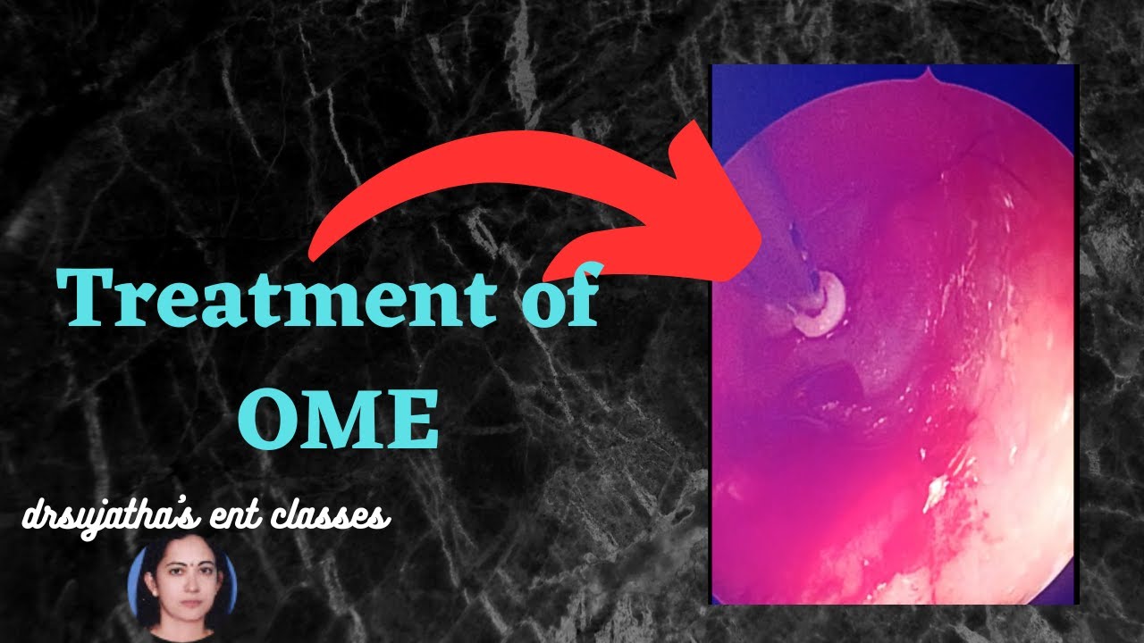 204.Myringotomy+ VT insertion #Treatment of OME #glue ear #grommet # ...