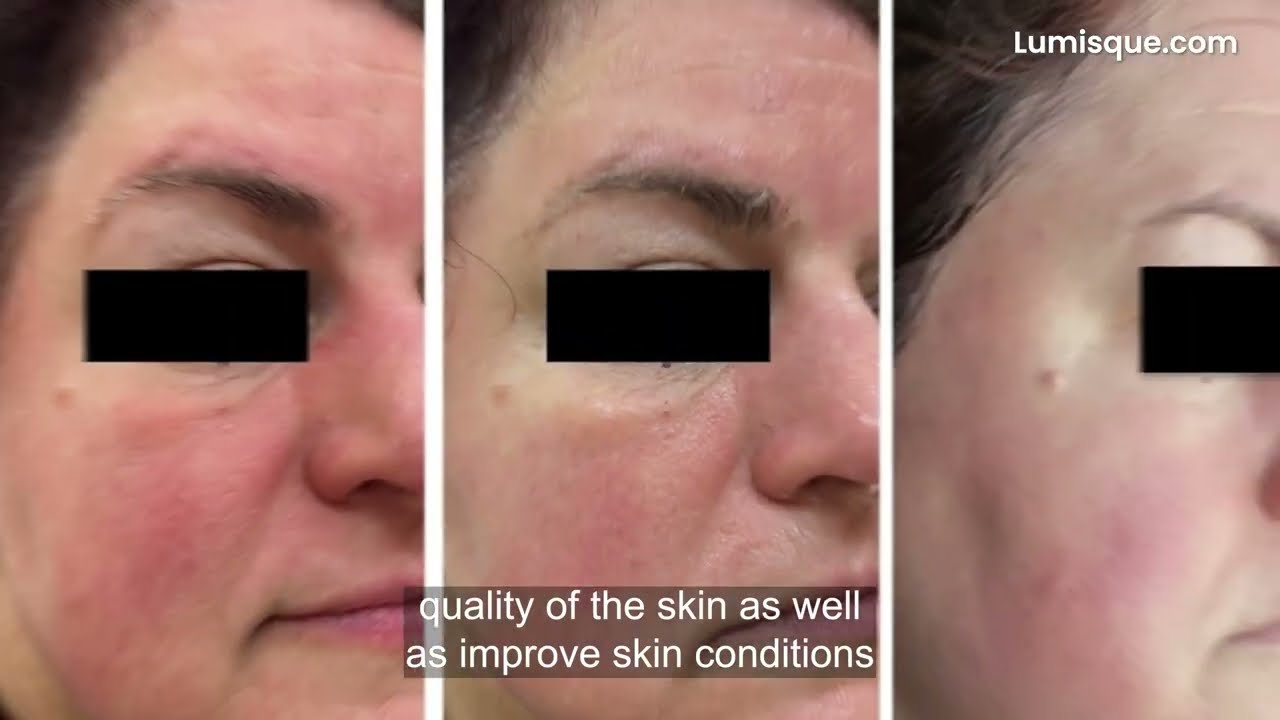 CO2LIFT PRO Carboxy Therapy Mask - YouTube