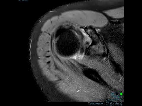 MRI Secrets Revealed: Unlocking Your Adhesive Capsulitis Diagnosis ...