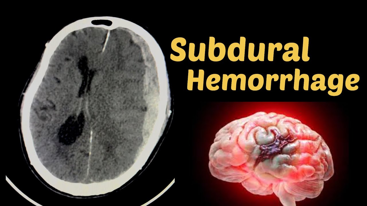 Subdural Hemorrhage SDH | Diagnosis | Brain 🧠 bleed 🩸| Radiology - YouTube