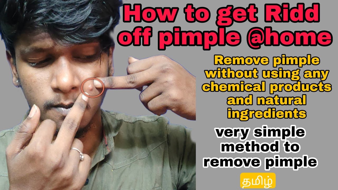 Simple way to Remove pimple | how to treat a pimple | Does and don't of ...
