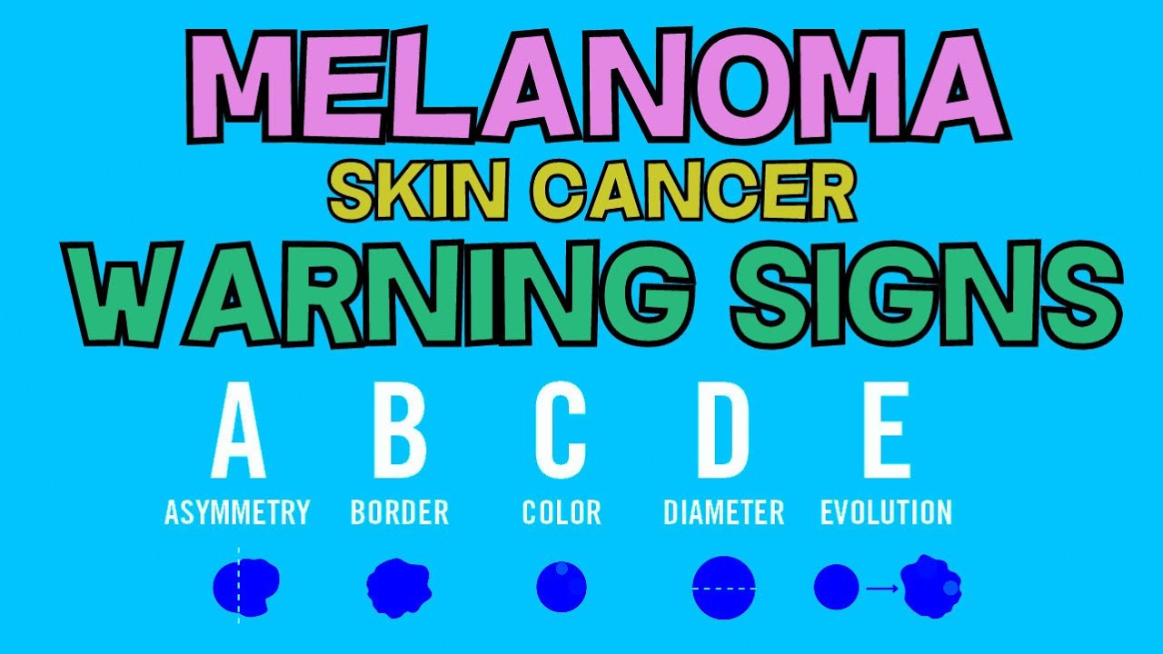 Melanoma Skin Cancer - Warning Signs - ABCDE Diagnostic Assessment ...