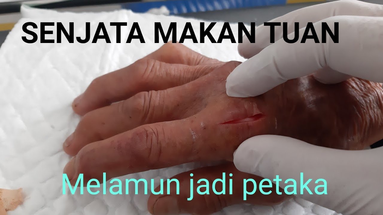 Menjahit luka sayatan parang - YouTube