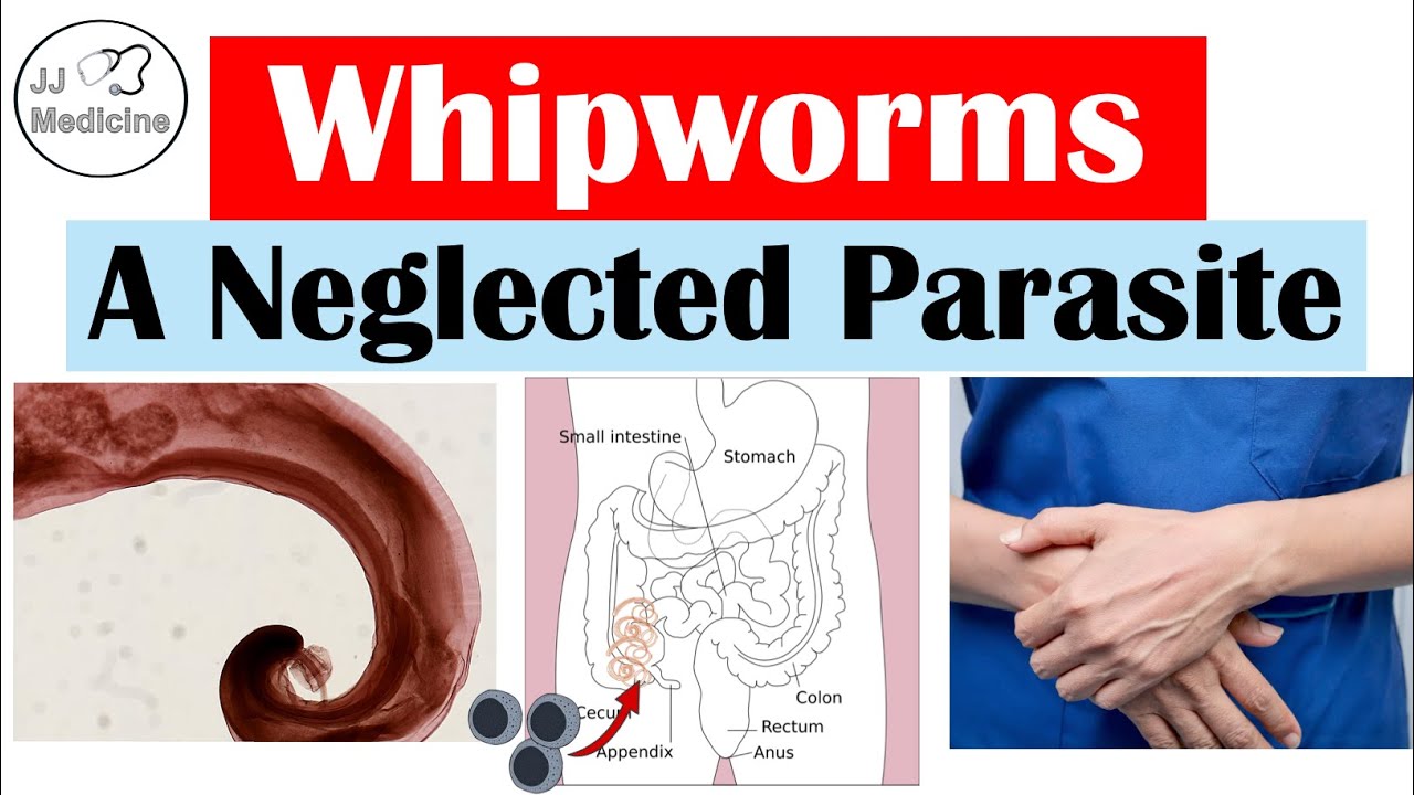 Whipworms (Trichuriasis) | How Do You Get Infected & Sick, Signs ...
