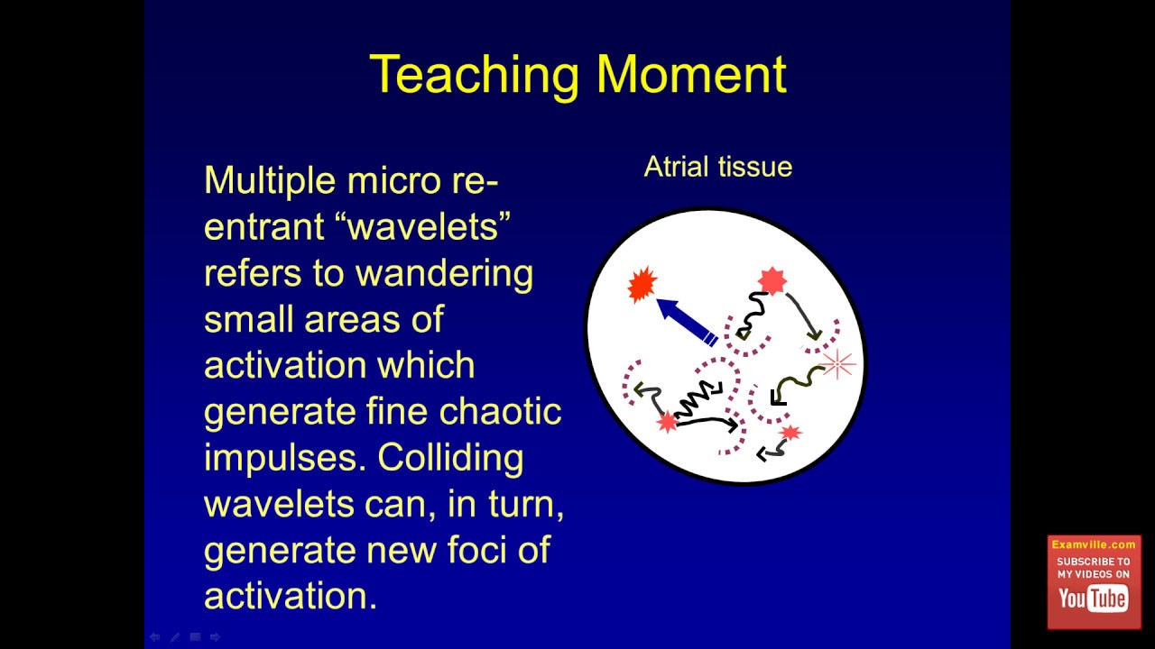 Normal Sinus Rhythm (NSR) - Interpreting ECG Rhythm Pattern - YouTube