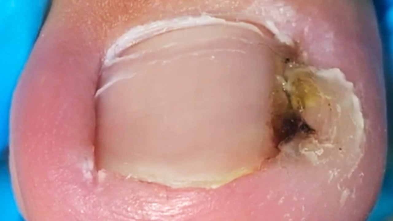 Swollen And Red Toes, With A Polyp On One Side; Carefully Remove The ...