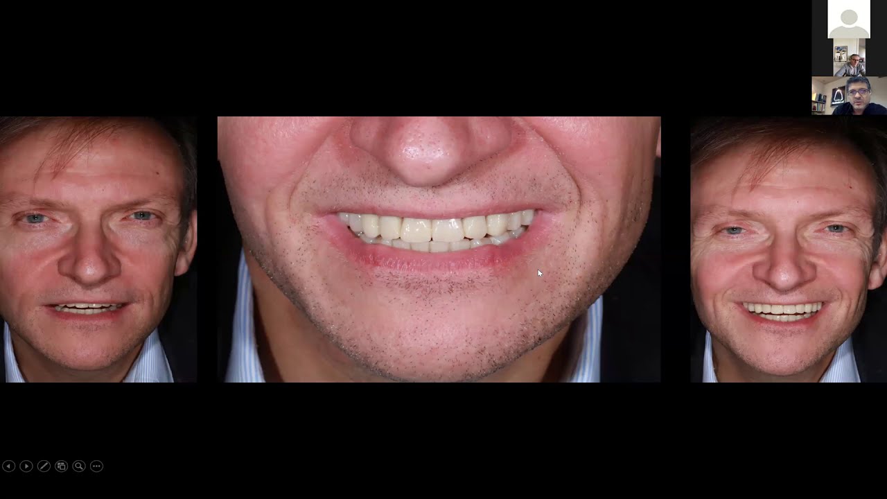 LIVE AID MASTERS OF DENTISTRY CAPITULO 5 "Nondas Vlachopoulos y Florin ...