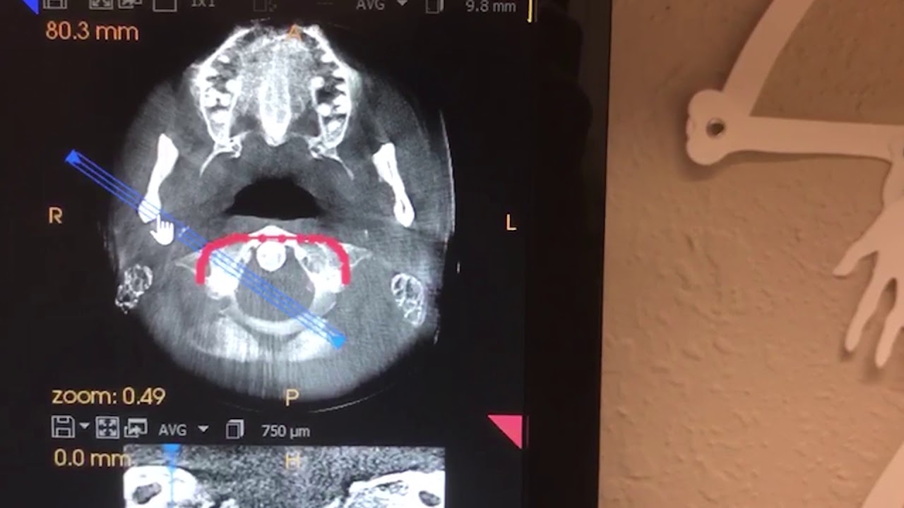 Blair 3-d model of subluxation confirmed on cone beam computerized ...