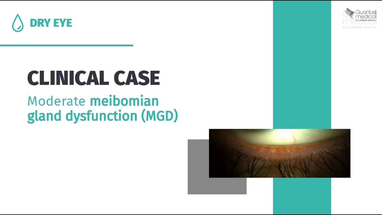 Clinical case - Moderate meibomian gland dysfunction (MGD) - YouTube