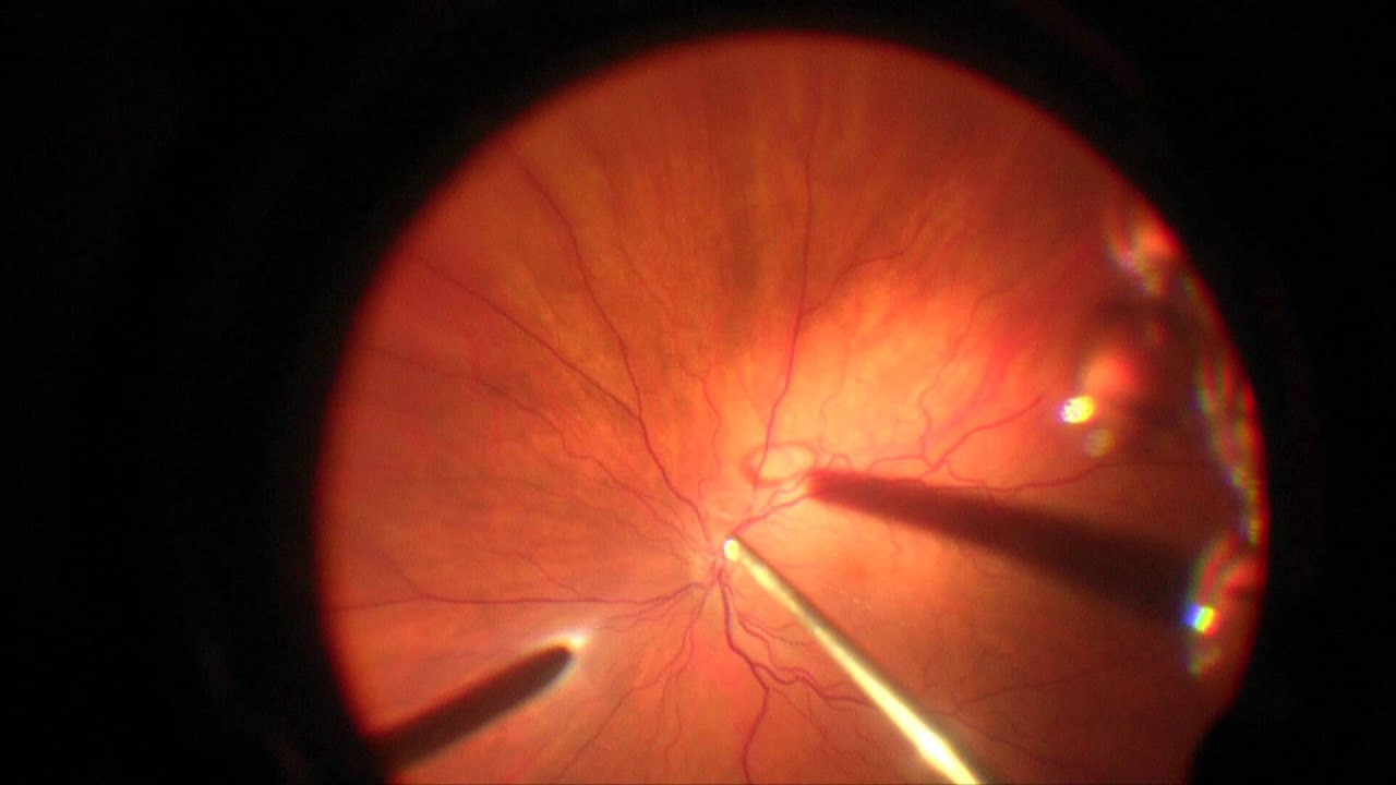 Retinal Procedures teaching video RESIGHT_Modul04 - YouTube