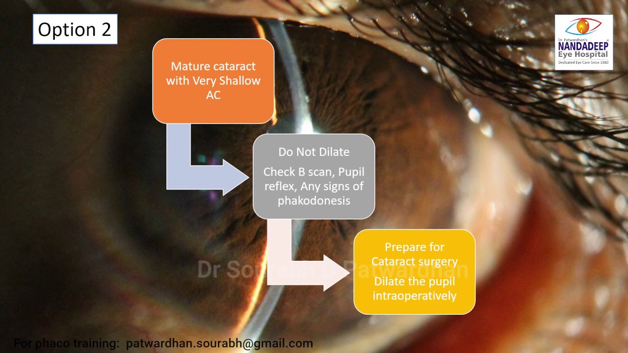 Mature cataract with very shallow AC- Intraoperative dilatation- Dr ...