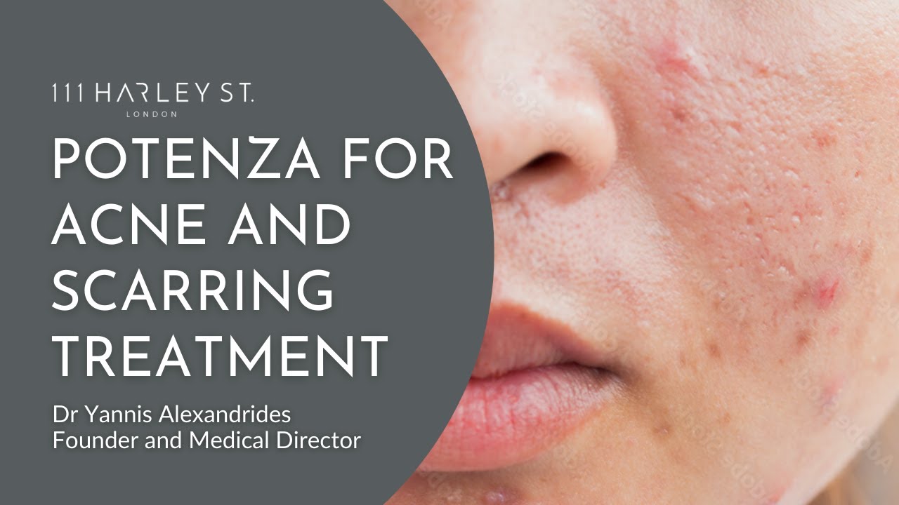 Potenza for Acne and Scarring Treatment | 111 Harley St. - YouTube