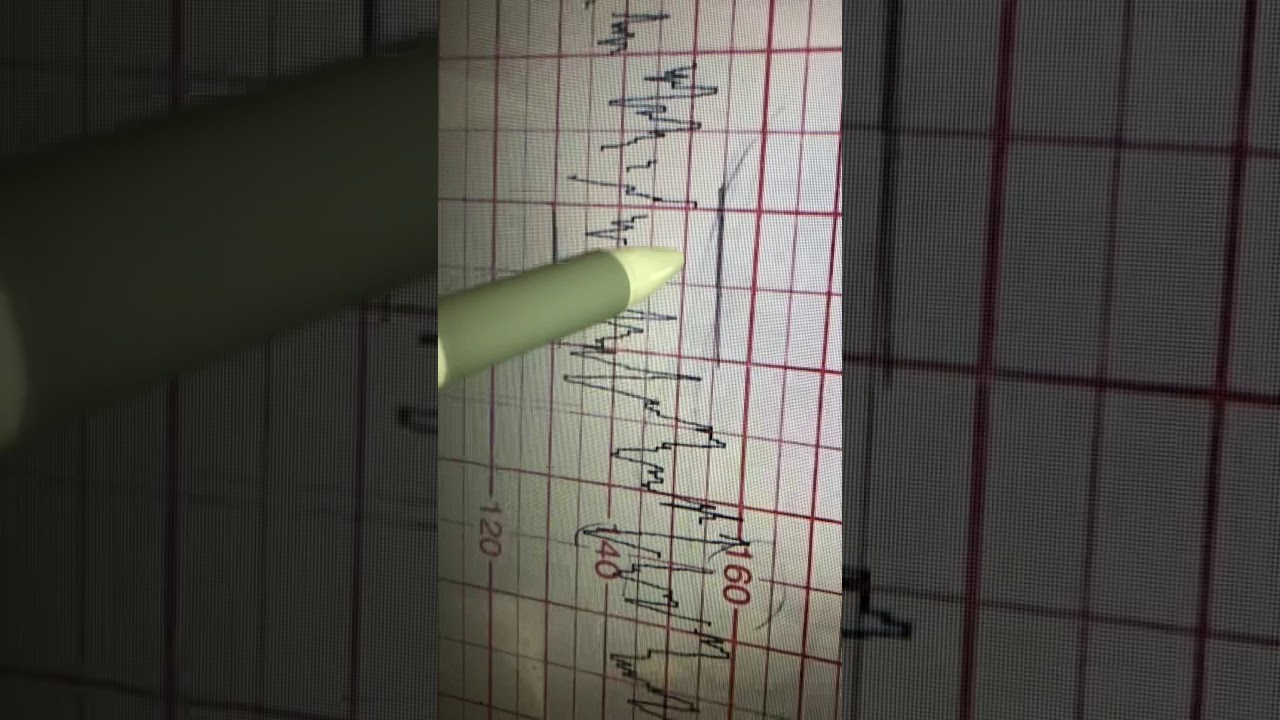 CTG interpretation - YouTube