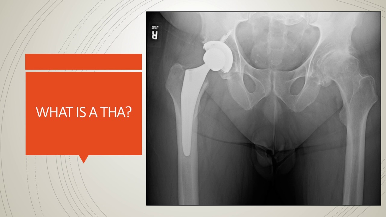 Total Hip Arthroplasty Approaches - Quality Improvement - YouTube