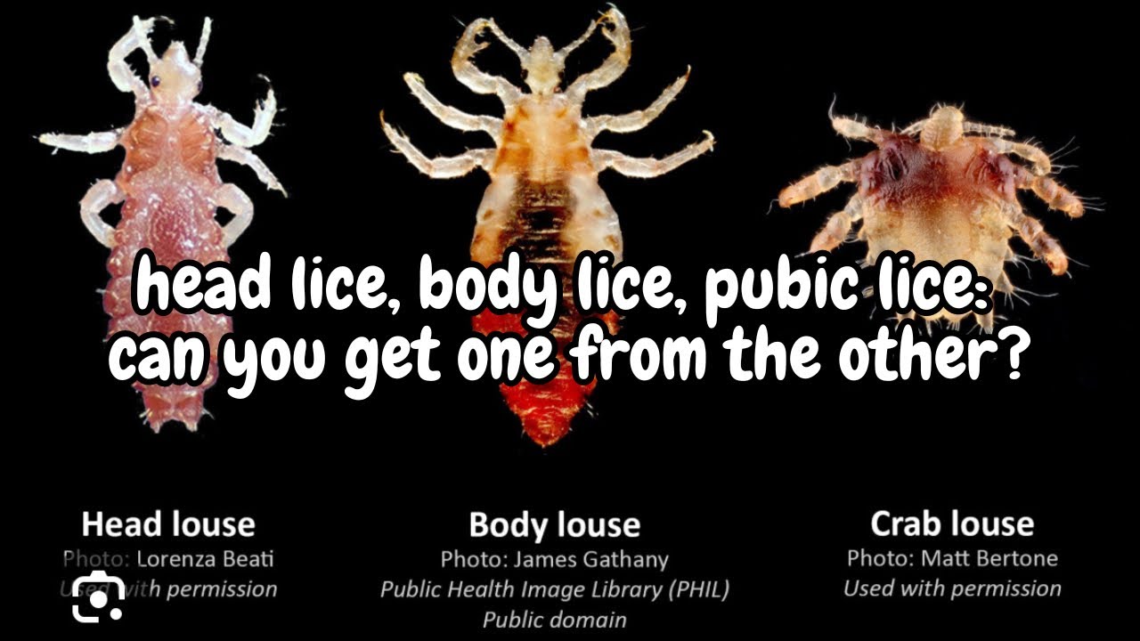 Head lice, body lice, pubic lice: the differences l lice removal ...