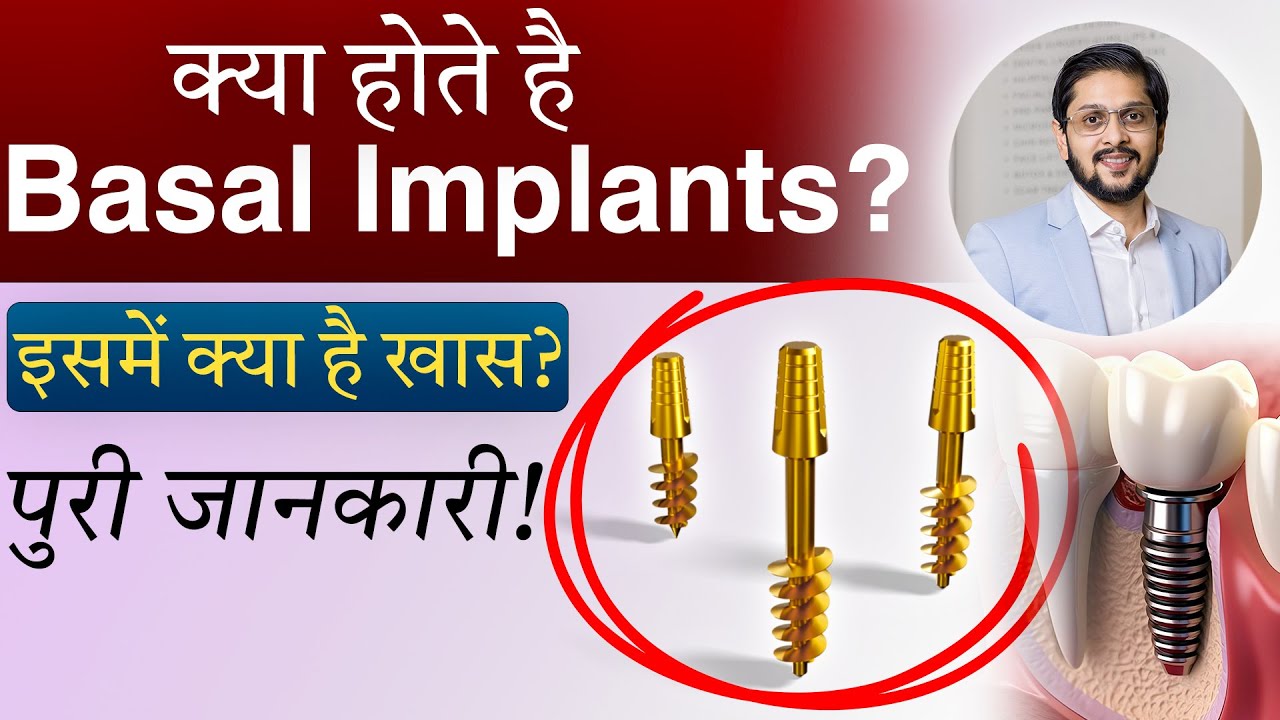 Basal Implants Explained 😍 Get Fixed Teeth in 3 Days | Benefits, Cost ...